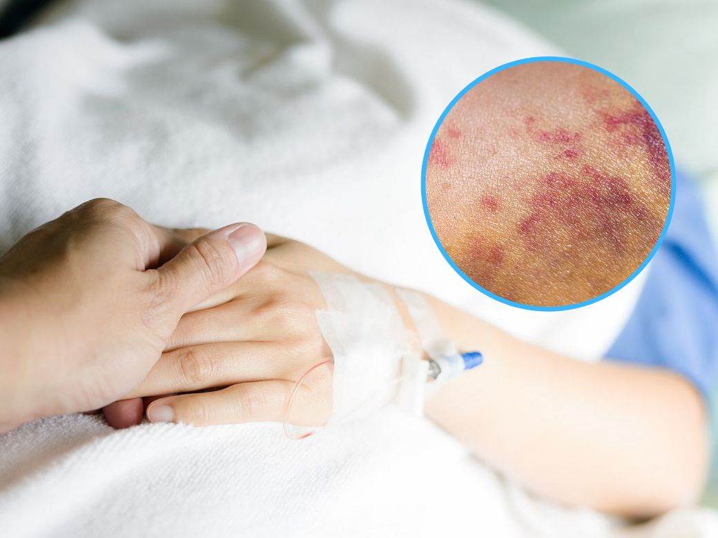 Simptomi leukemije | Lepa i srećna