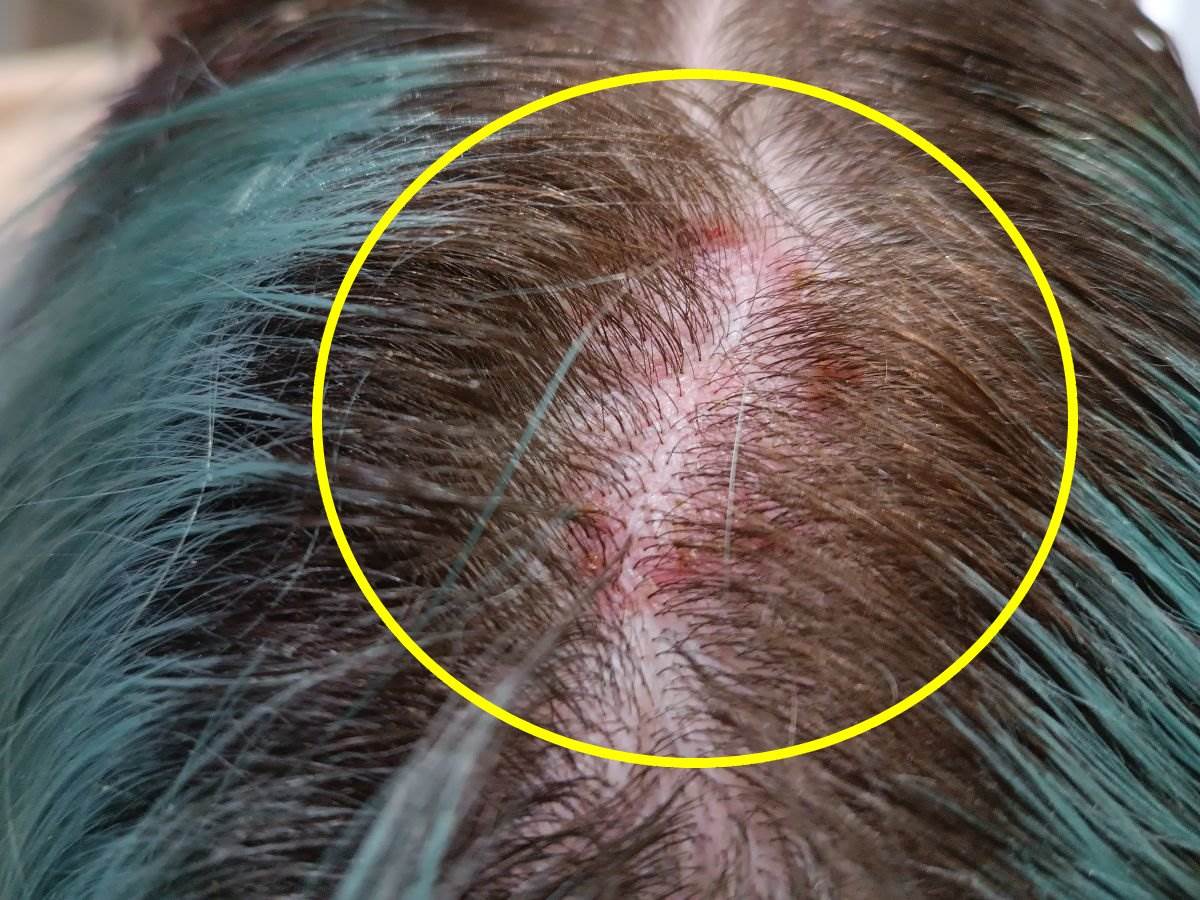 Crvenilo na temenu glave i svrab | Lepa i srećna