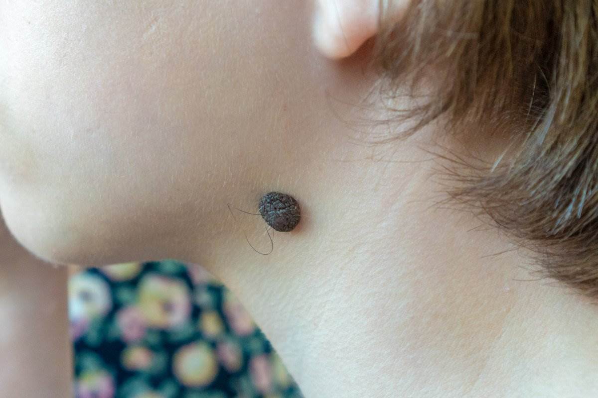Zašto dlake rastu na mladežu? | Lepa i srećna