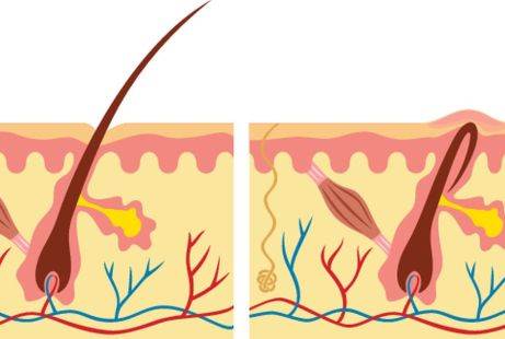 URASLA DLAKA MOŽE BITI OPASNA: ako primetite ovo na koži obavezno idite ...
