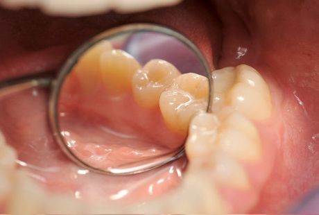 OTVORITE USTA I POGLEDAJTE SE U OGLEDALO! AKO OVO IMATE, HITNO KOD ...