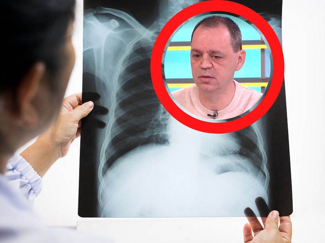 rendgen pluca bele senke crne voda u plucima korona kovid upala | Lepa ...