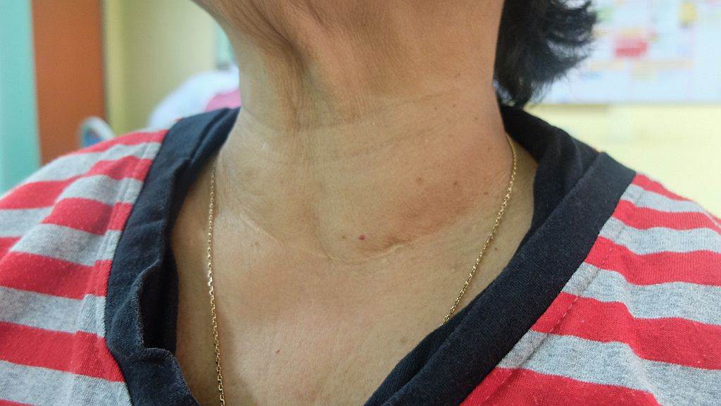 tiroidna oluja simptomi | Lepa i srećna